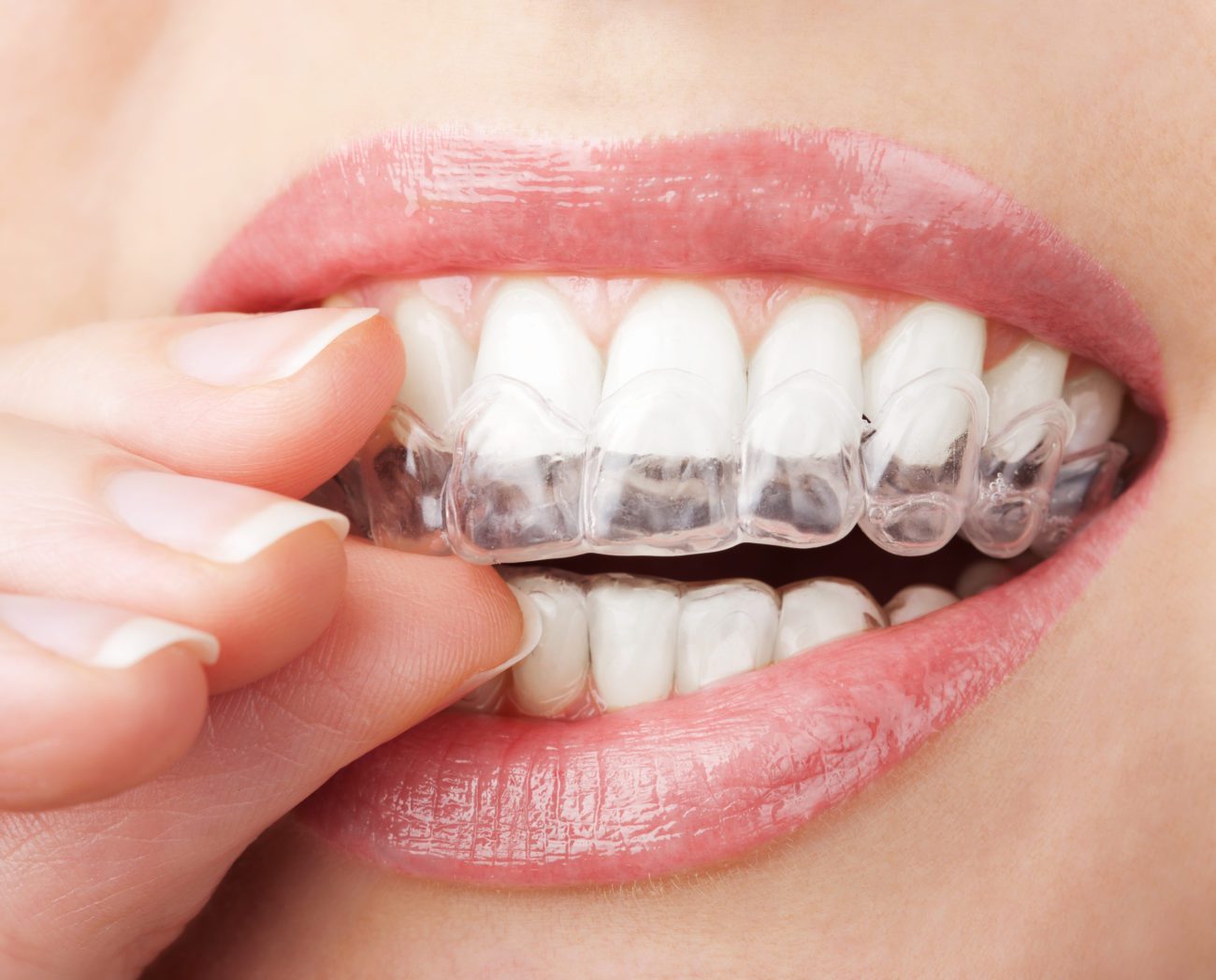 Invisalign in Washington DC | Clear Aligners Shaw