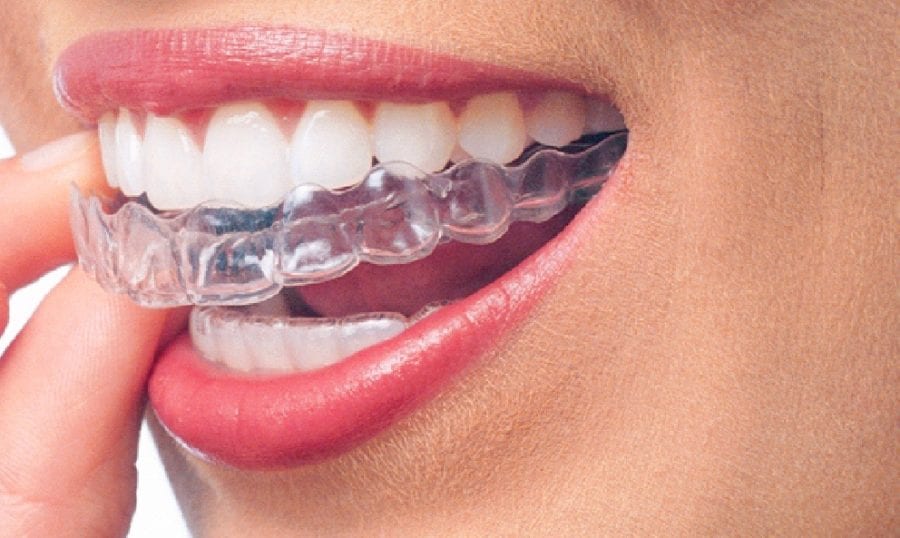 What To Know About Invisalign | DC Precision Dentistry