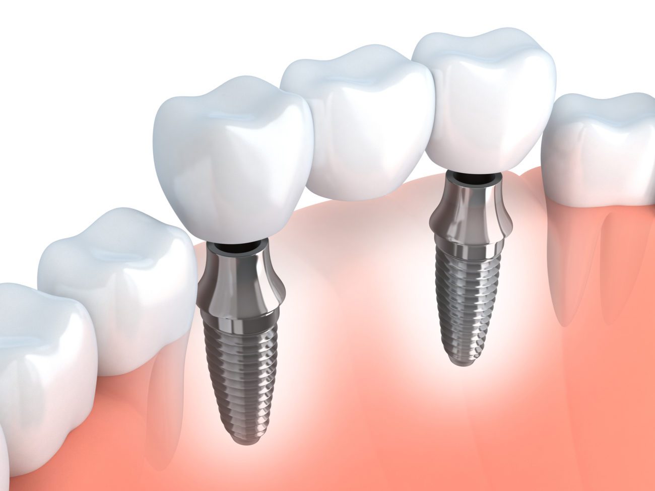 Multiple Dental Implants Washington DC | Precision Dentistry